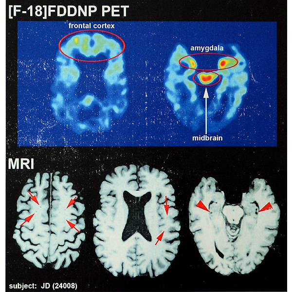 What is CTE? All About Chronic Traumatic Encephalopathy, the Disease ...